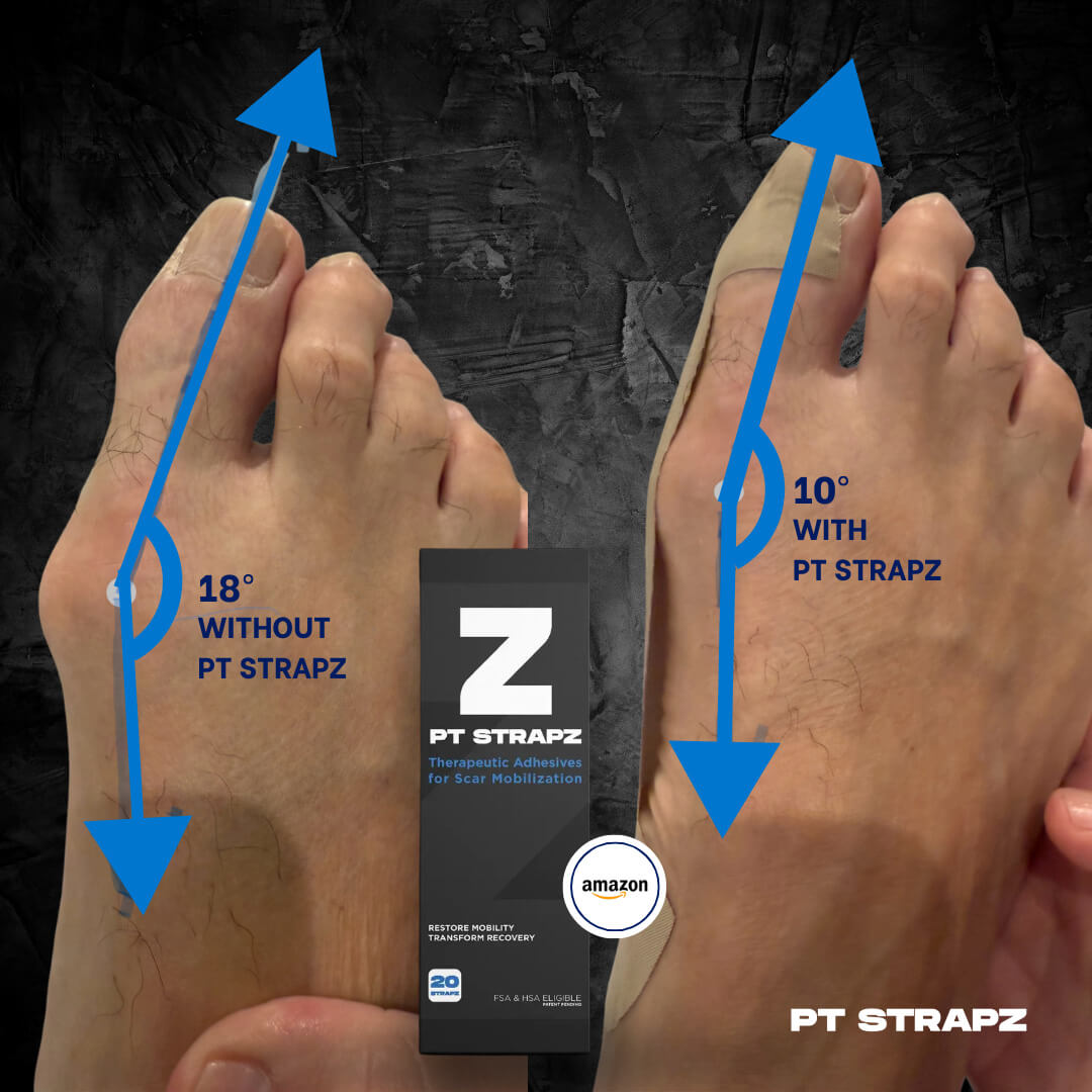 PT Strapz - Advanced Scar Tissue Treatment